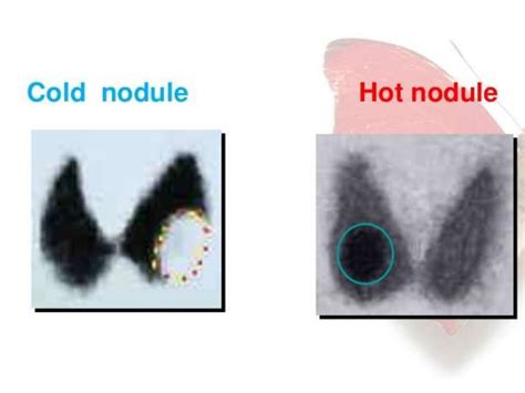 Nuclear Medicine Thyroid Procedure Scan