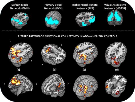 Independent Component Analysis Ica Showing Decreased Functional Download Scientific Diagram