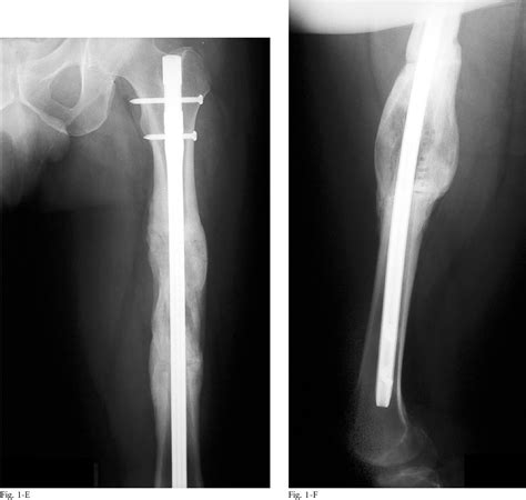 Figure 1 From The Clamshell Osteotomy A New Technique To Correct