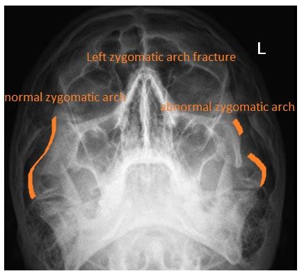 Zygomatic Arch Fracture