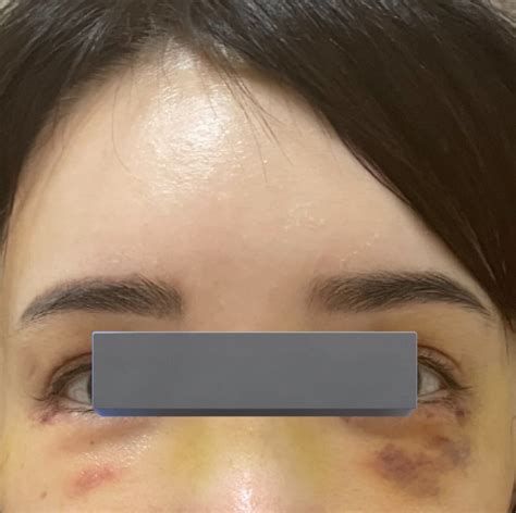 𝙺𝙰𝙽𝙽𝙰 𝟕月 on Twitter ヨンセUP額挙上鼻筋リフト眉間しわ遮断術DT9日目昨日より微かに内出血薄くなった気