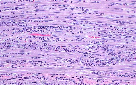 Acute Appendicitis Light Micrograph Stock Image C058 1077 Science Photo Library