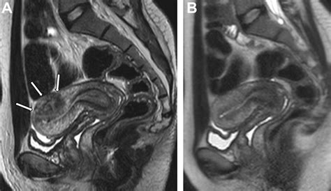 Adenomyosis On Mri Scan