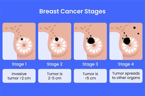 Breast Cancer Symptoms Causes Stages Diagnosis And Treatment Oncodaily