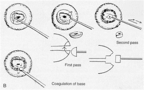 Electrosurgical Loop Excision Of The Cervix Primary Care Clinics In Office Practice