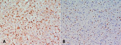 Diffuse Astrocytoma With Expression Of Mutant Idh1 Protein A And Loss Download Scientific