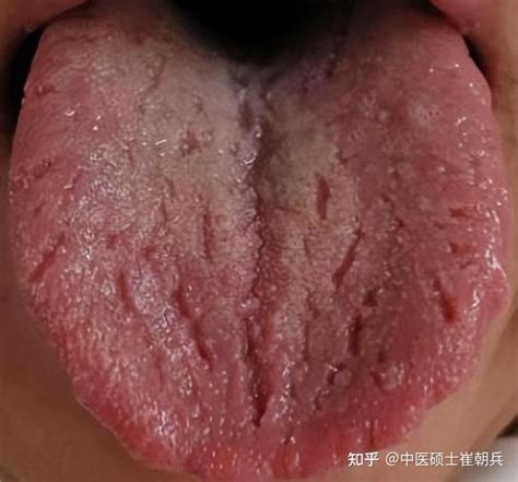 舌头有裂纹5种原因9种舌象看看你是属于哪一种 知乎