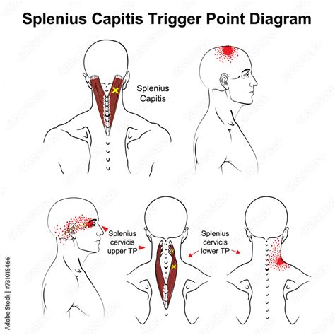 Splenius Capitis Trigger Point Vector Diagram Stock Vector Adobe Stock
