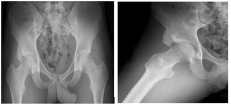 Standard Ap Xray A And Dunn Lateral View B Download Scientific