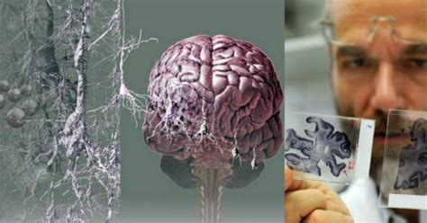 ვის ემუქრება დემენცია სიბერეში აკადემიკოს ბახტერევის ამომწურავი პასუხი სასარგებლო რჩევები