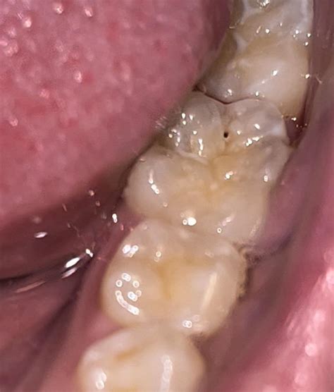 Black Dot On Tooth Is This A Cavity How Fast Do I Need To Go To A