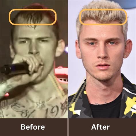 Mgks Hair Transplant Before And After Transformation