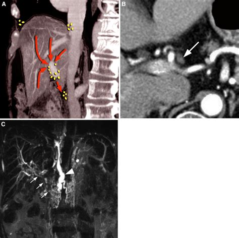 Deep Lymphatic System Of The Liver Portal Tract A The Reformatted