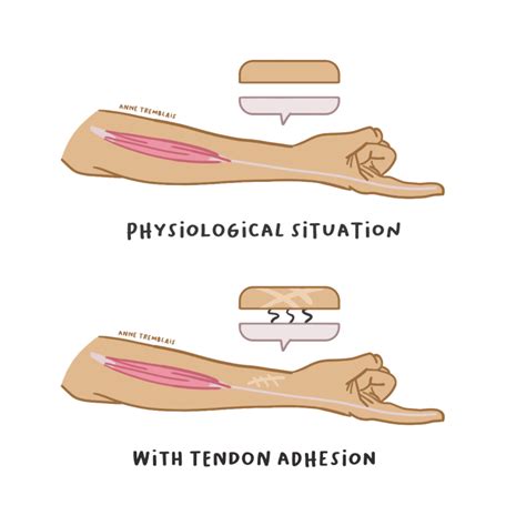 London Scar Therapy On Linkedin A Great Animation Of The Impacts Of Scar Tissue On Functional