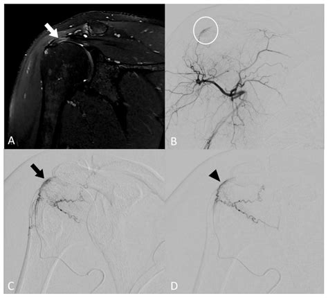 Safety And Efficacy Of Embolization With Microspheres In Chronic