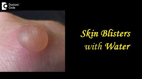 Water Blister And Red Rash At Paul Bullock Blog