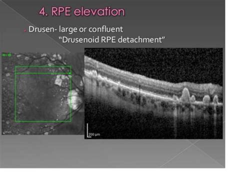Pigment Epithelial Detachment Ped Pptx Eye And Vision Conditions