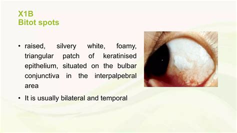 Xerophthalmia Wps Officepptx