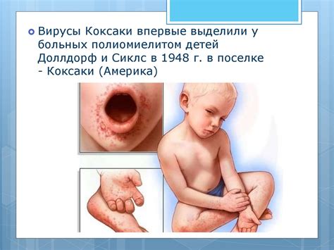 Вирусы коксаки А и В Echo вирусы Энтеровирусы человека 68 71 типа презентация онлайн