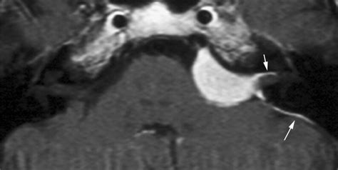 Meningioma Of The Cpa A Mass Lesion Eccentric To The Porus And