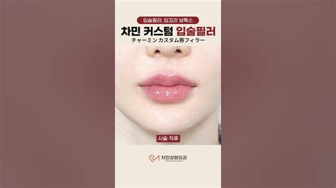 모양 불만족으로 입술필러 재시술을 고민한다면 차민 커스텀 입술필러 💋 입술 입꼬리 인중축소효과까지 러시안립필러 인중축소 입술필러후기 Youtube