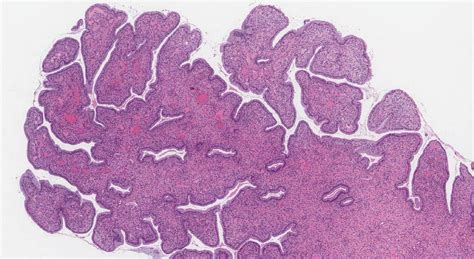 Endocervical Polyp Ottawa Atlas Of Pathology
