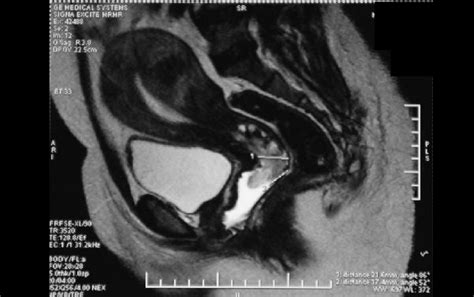 Pelvic Mri Showing A Tumor Developing In The Left Postero Lateral Side