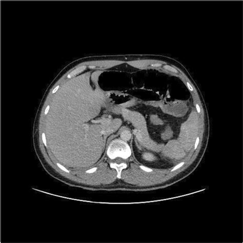 Normal Abdominal Computed Tomography Scan With Contrast Portal Phase Download Scientific