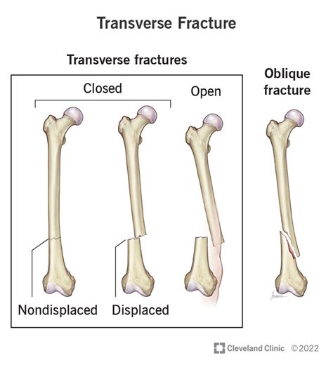 Types Of Bone Fractures Causes Symptoms And Treatment