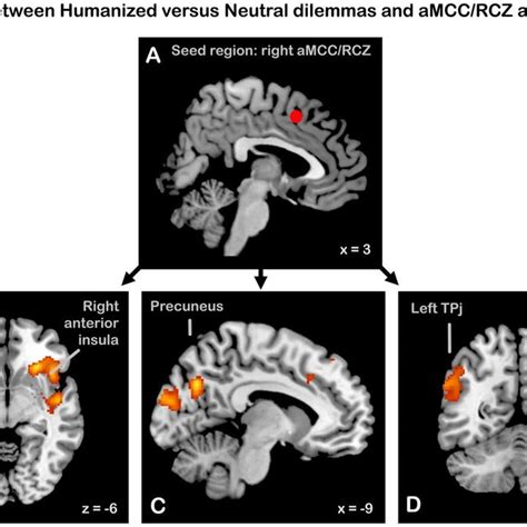 A Bilateral Perigenual Anterior Cingulate Cortex Pgacc Ventromedial Download Scientific