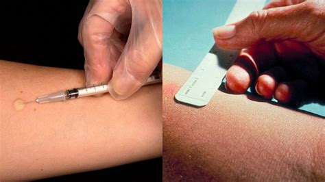 Rapid Plasma Reagin Rpr Test Principle Procedure Result Applications Biology Notes Online