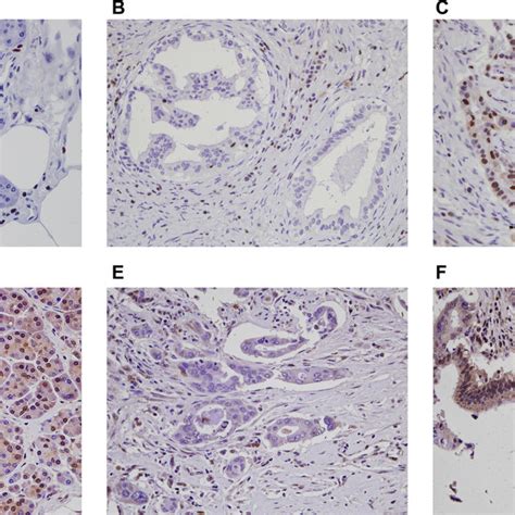 Immunohistochemical Stain Results For Runx3 And Smad4 In Pdacs And