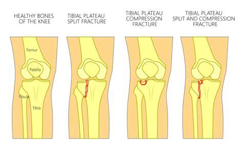 Knee Fractures Chris Bailey Orthopaedics