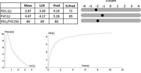 Spirometry Results For A 453 Year Old Caucasian Male Height Of 1802