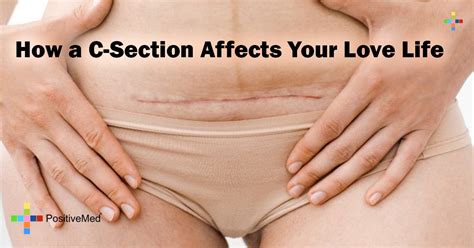 This Is How A C Section Affects Your Sex Life
