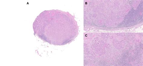 A The Lymph Node Architecture Is Distorted By This Multinodular