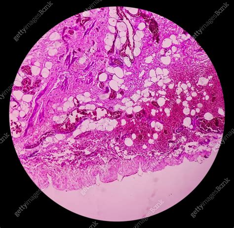 Tissue From Gallbladder Cyst Microscopic Image Of Choledochal Cyst Selective Focus 40x View
