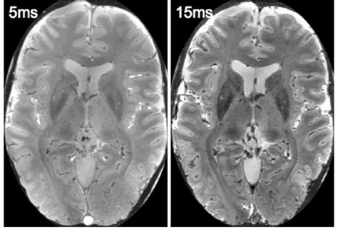 A Representative Slice Of The Brain Acquired With A Gre Sequence At 94