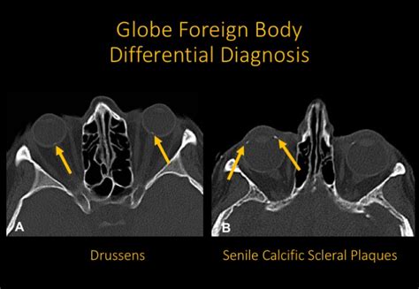 Senile Scleral Plaque