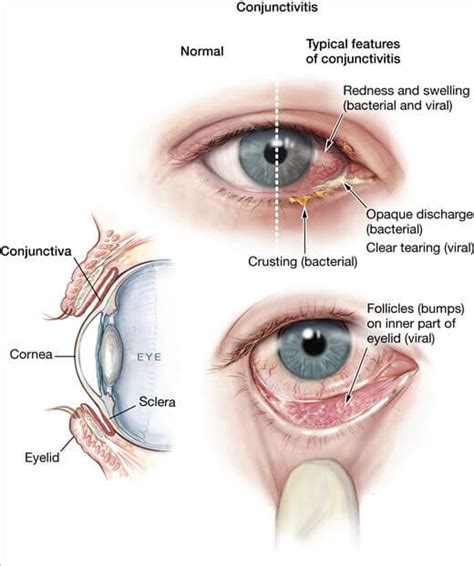Tatum Eyecare Important Pink Eye Information To Know