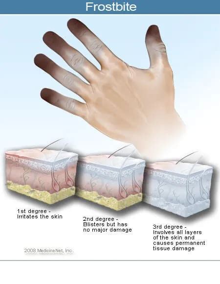 Frostbite Frostnip Treatment Symptoms Prevention