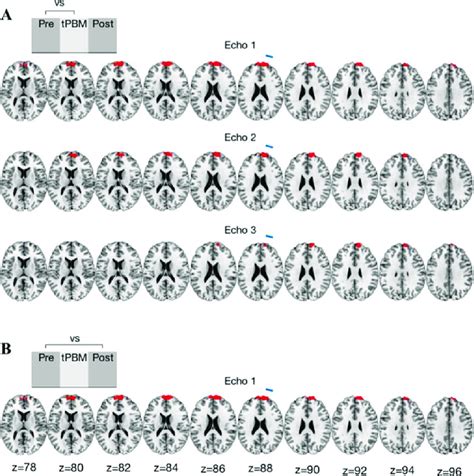 Tpbm Modulates Fmri Bold During And After Stimulation A An Acute Download Scientific Diagram