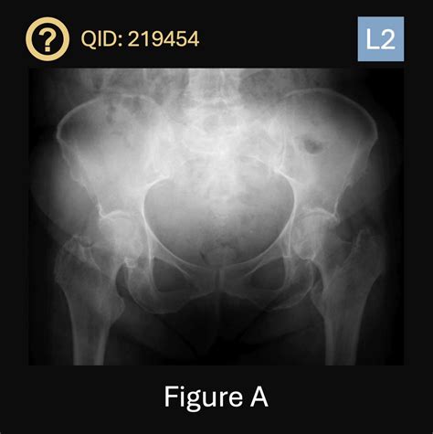 Orthobullets New Expert Video By Hafiz F Kassam Md Newportshoulder Of