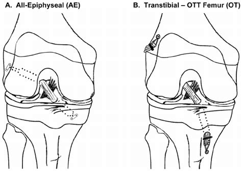 ACL Reconstruction Techniques Download Scientific Diagram