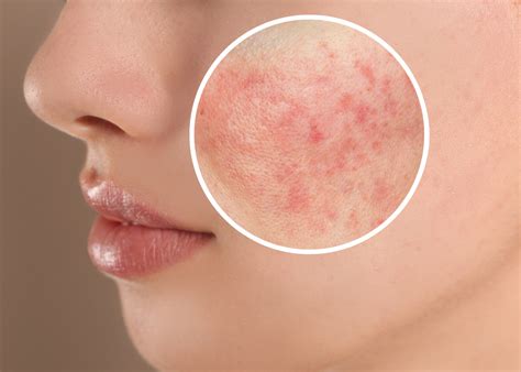 Rosacea Treatment In Singapore Healthspring