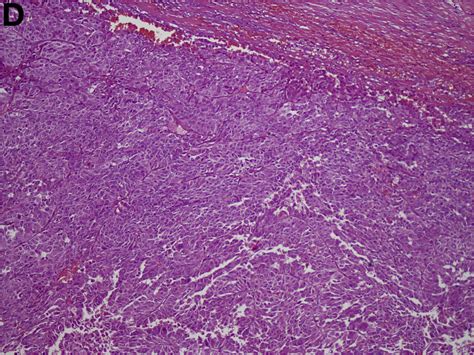 Unusual Cause Of An Umbilical Nodule Gastroenterology