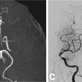 A Diffusion Weighted MRI Revealed An Infarct In The Left Middle Download Scientific Diagram