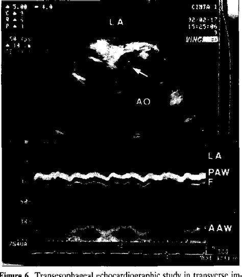 [pdf] Diagnosis Of Ascending Aortic Dissection By Transesophageal Echocardiography Utility Of M