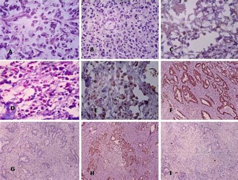 A Case Of Signet Ring Carcinoma Colon Download Scientific Diagram