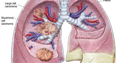 Asbestos Jar Mesothelioma Asbestos Lung Cancer Asbestosis And